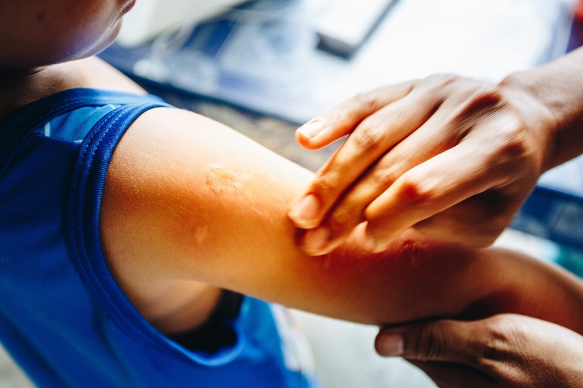8 Best Bets for Easing Pain from Insect Bites and Stings